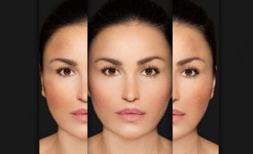 How Melanin (Dark Pigmentation) Works | | Clear Essence®